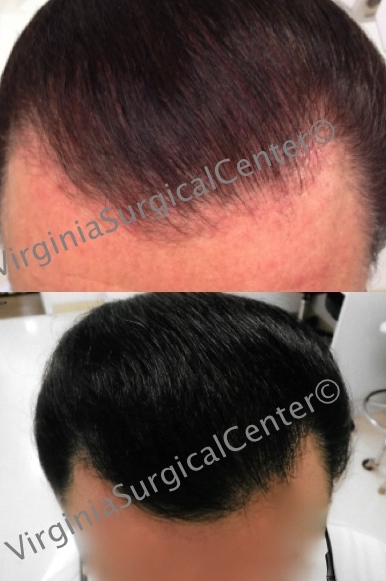 Before and After Trichophytic Donor Closure Technique | Virginia ...