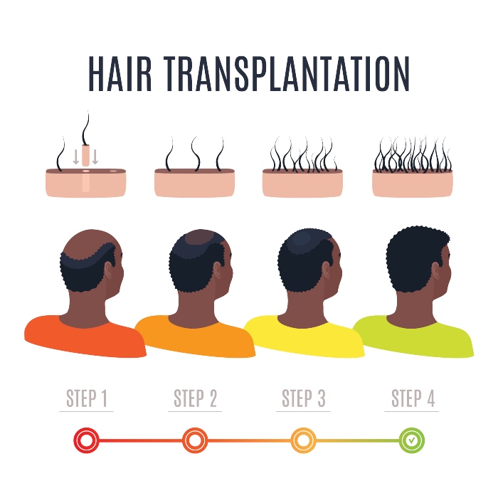 Learn About The Hair Transplant Success Rate